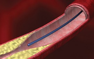 Integer: Leader in medical device outsourcing (MDO) - Products ...