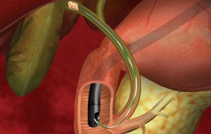 Integer | Interventional Guidewires